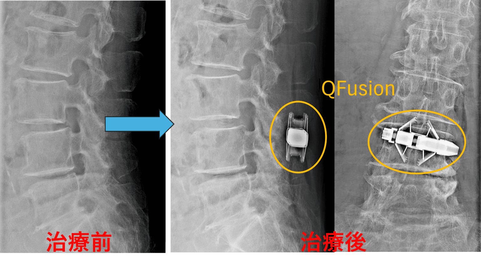 本日の治療症例紹介【Qフローレンス法】 CASE-No.20｜ILC国際腰痛クリニック（大阪）コラム | ILC国際腰痛クリニック【公式サイト】